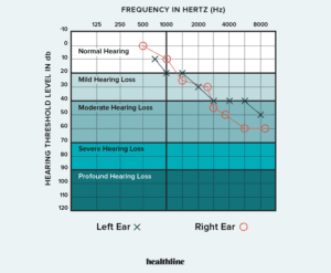 Membaca Audiogram: Membaca Hasil Tes Pendengaran Anda - Brilliant Hearing